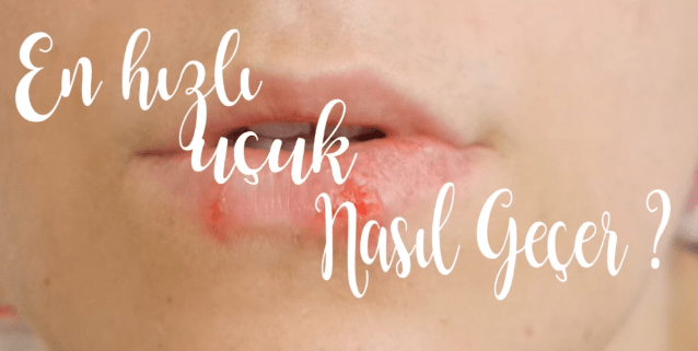 Aklovir Uçuk Kremi Nasıl Kullanılır, Fiyatı Nedir, Kullananlar Memnun ...